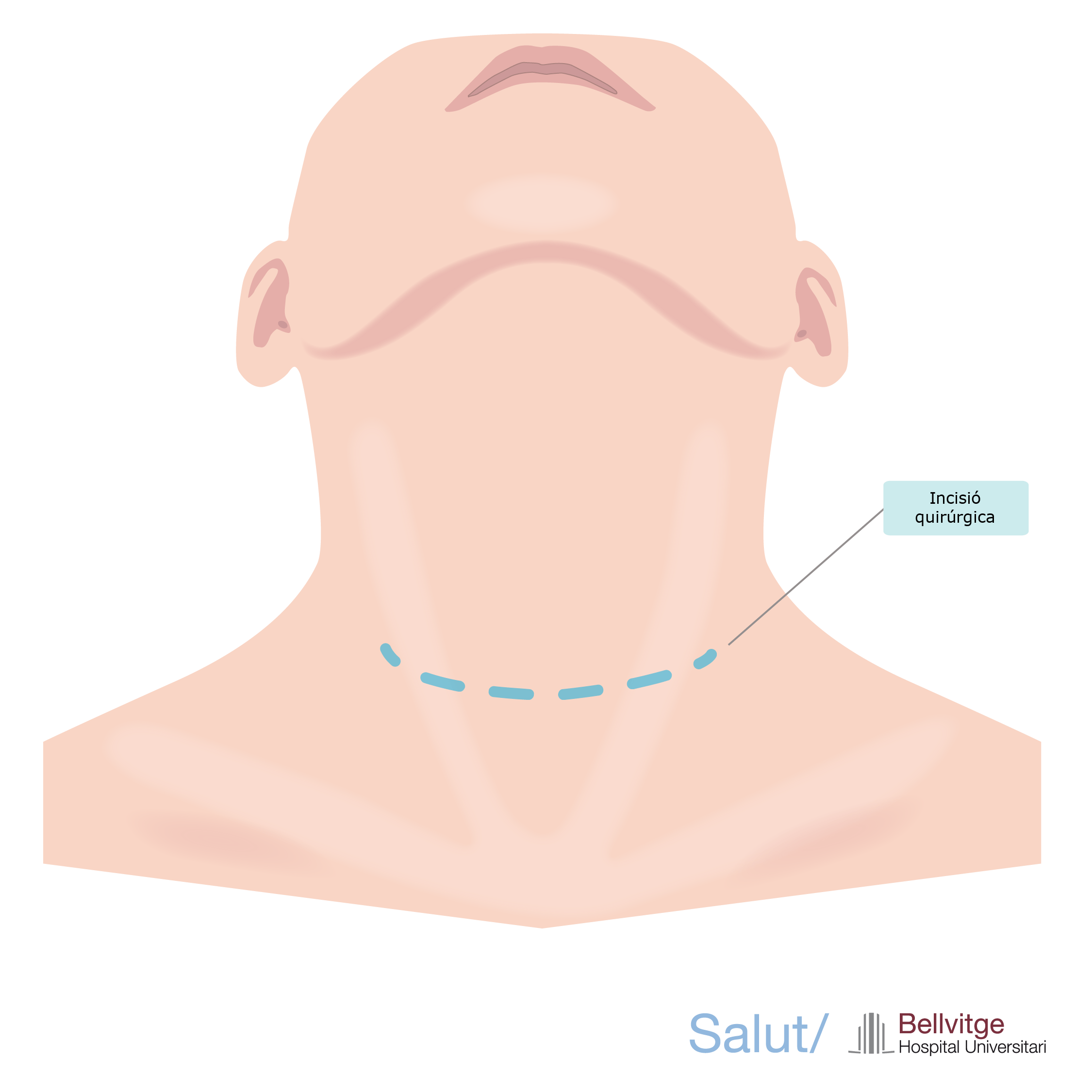 Tiroidectomía: principales detalles | Hospital de Bellvitge
